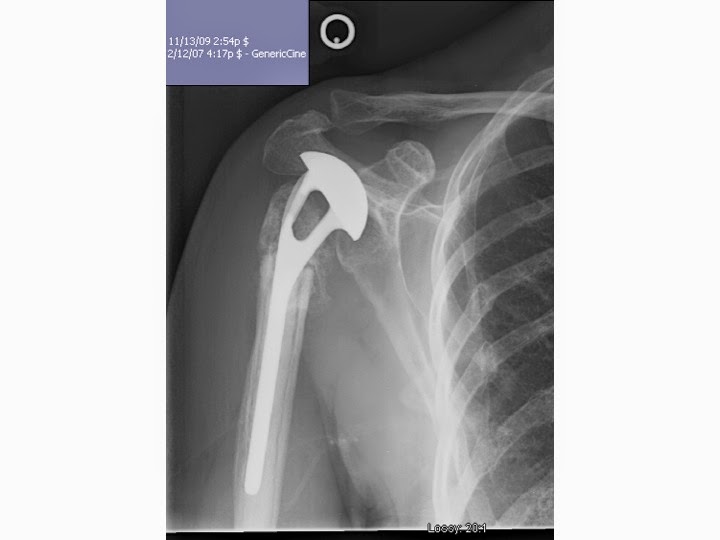 Shoulder and Elbow Surgery: Reverse shoulder replacement for failed ...