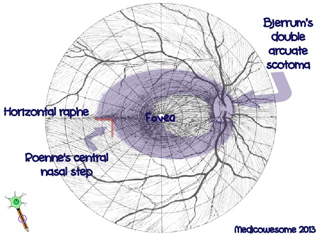 Medicowesome — Progression of visual field defects in Glaucoma...