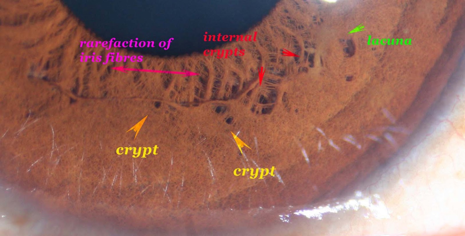 Modern & Multidimensional Iridology: Crypts at Pupillary Zone & Border ...