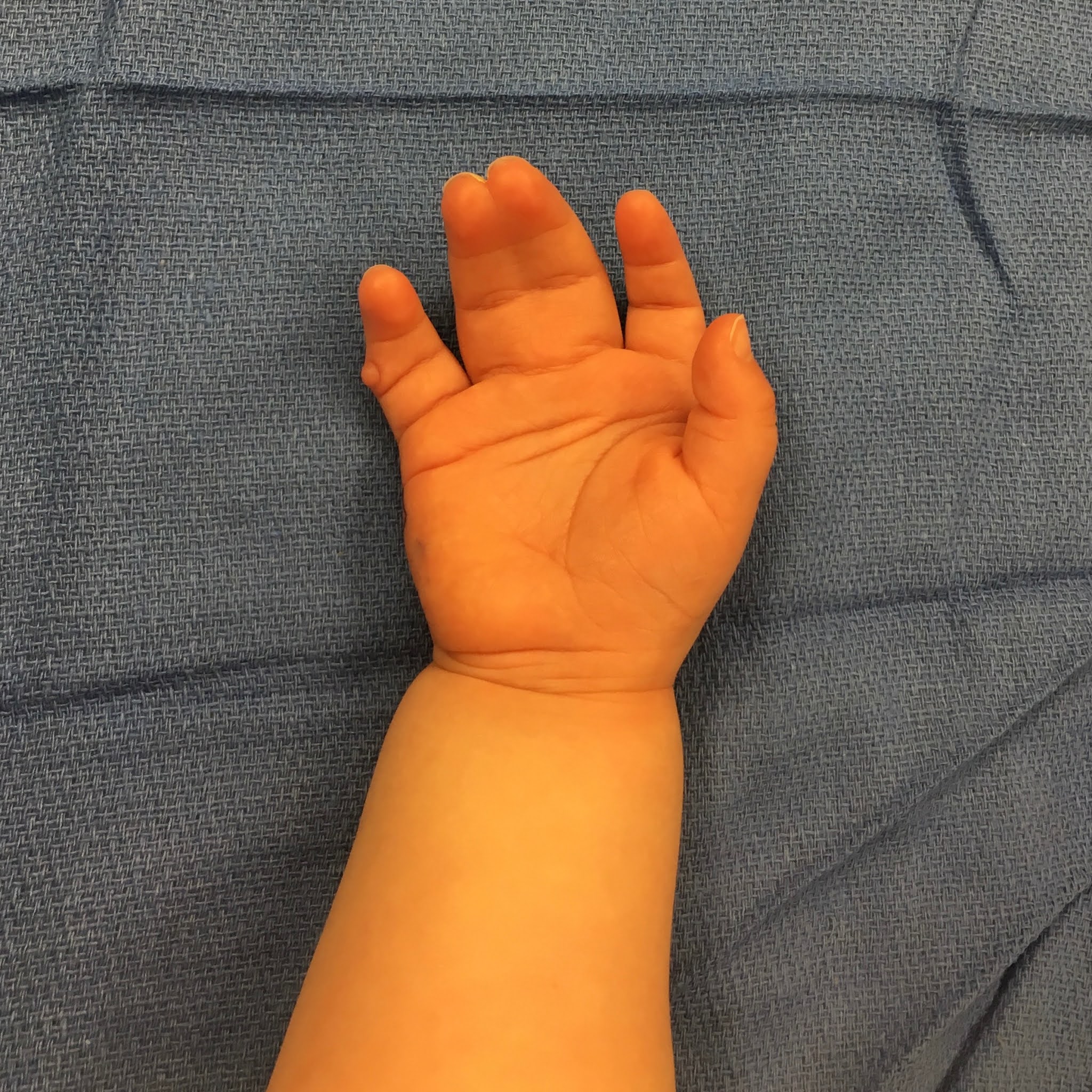 Syndactyly, Macrodactyly, and Keloid | Congenital Hand and Arm ...