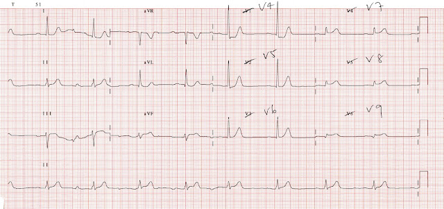 Posterior ST Elevation Myocardial Infarction | INA - ECG