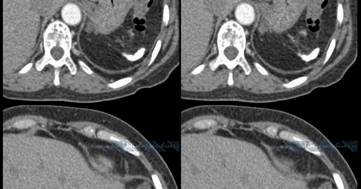 Radiology Archives: Αυτοσπληνεκτομή (Δρεπανοκυτταρική Νόσος)
