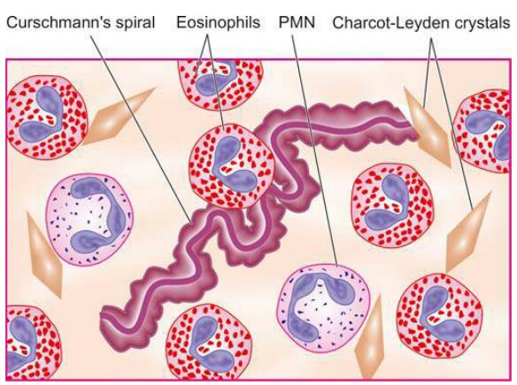 Bronchial asthma