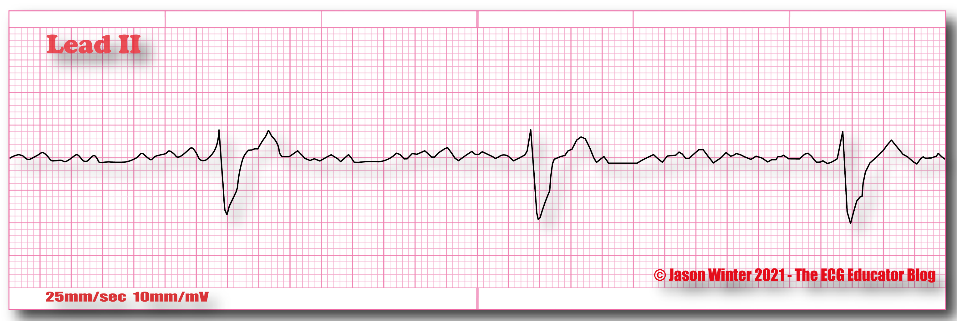 ECG Educator Blog : Atrial Fibrillation (AF)