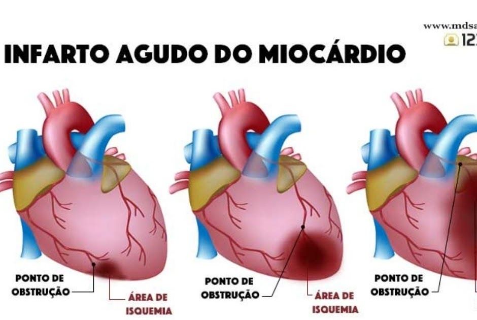 Causas Del Infarto Fulminante - RETOEDU