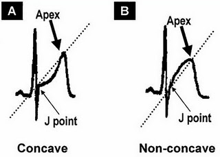 Doc Cottle's Desk: Benign early repolarization