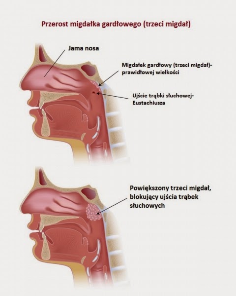 Na Języku - Pomoc Logopedyczna: Problem migdałkowy
