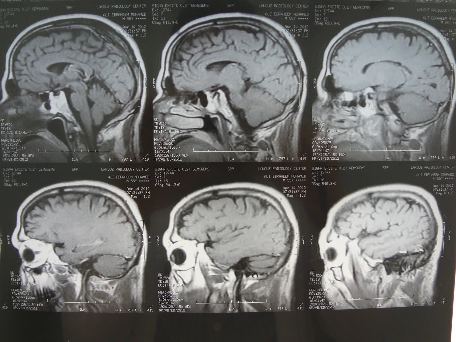 lt temporal lobe abscess complicating attico antral cholesteatoma MRI ...