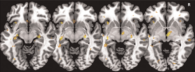 The Neurocritic: The Idiosyncratic Side of Diagnosis by Brain Scan and ...