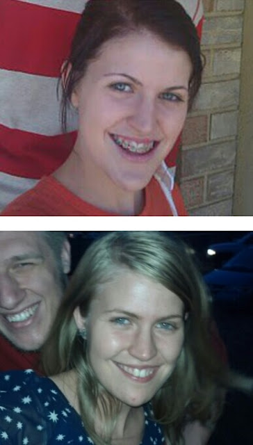 For the fellow surgery goer and brace face like me