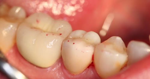 Occlusal Adjustment Definition, Procedure, Side Effects, TMJ, Cost ...