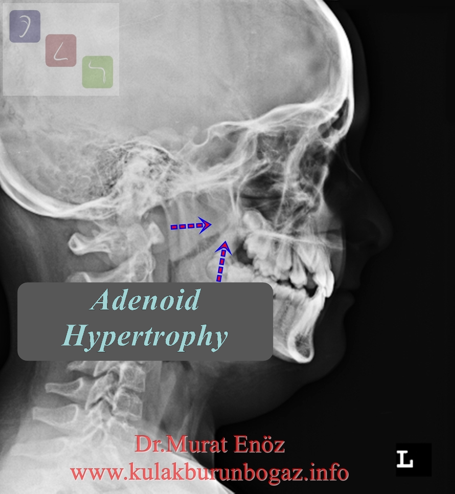 Adenoid Hypertrophy X Ray