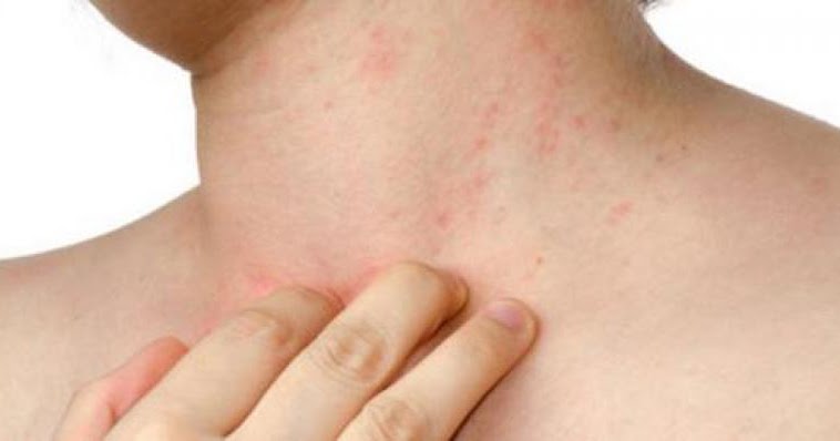 bensağlık: Dabaz Hakkında Bilmeniz Gerekenler