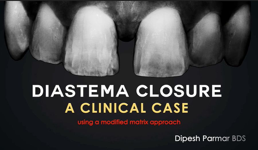CLINICAL CASE: Diastema Closure Perfection - Using a modified matrix ...
