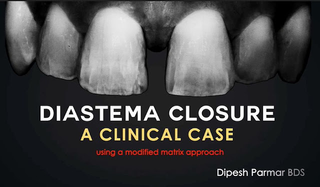 CLINICAL CASE: Diastema Closure Perfection - Using a modified matrix ...
