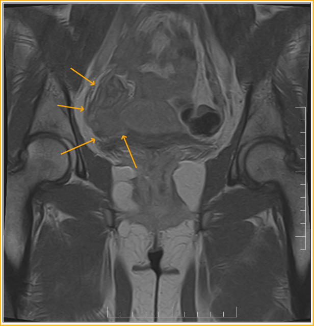 Acute PID-MRI - Sumer's Radiology Blog