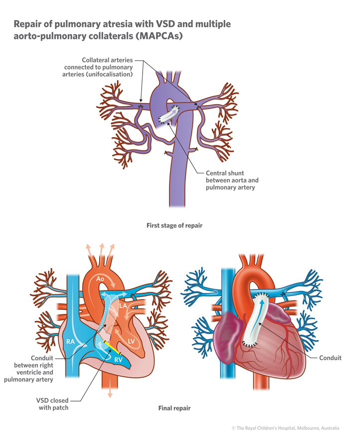Play It Where It Lies: Congenital Heart Defect--Pulmonary Atresia