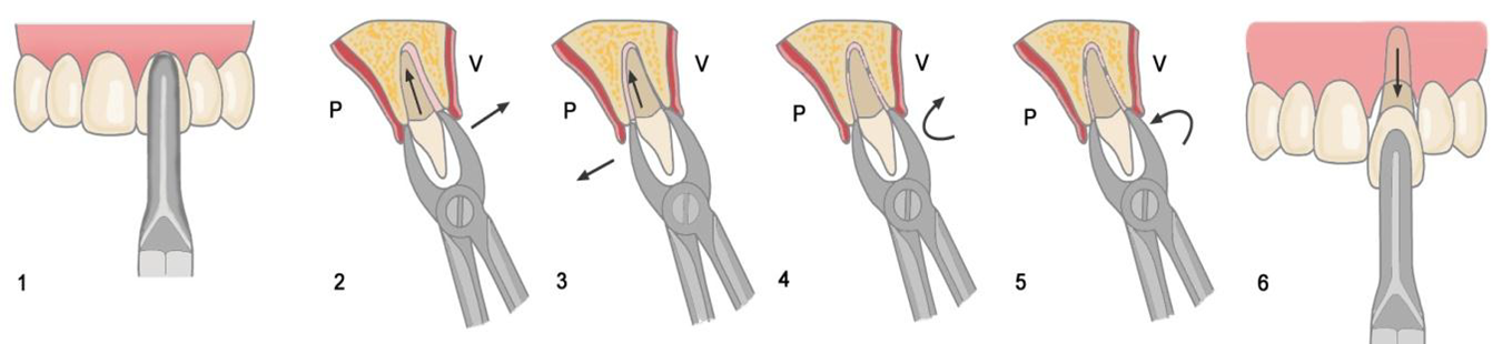 Técnicas de exodoncia.