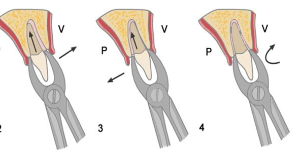 Técnicas de exodoncia.