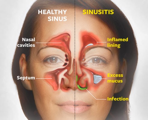 TREATMENTS IN AYURVEDA - MY CLINICAL EXPERIENCES: SINUSITIS OR DUSHTA ...