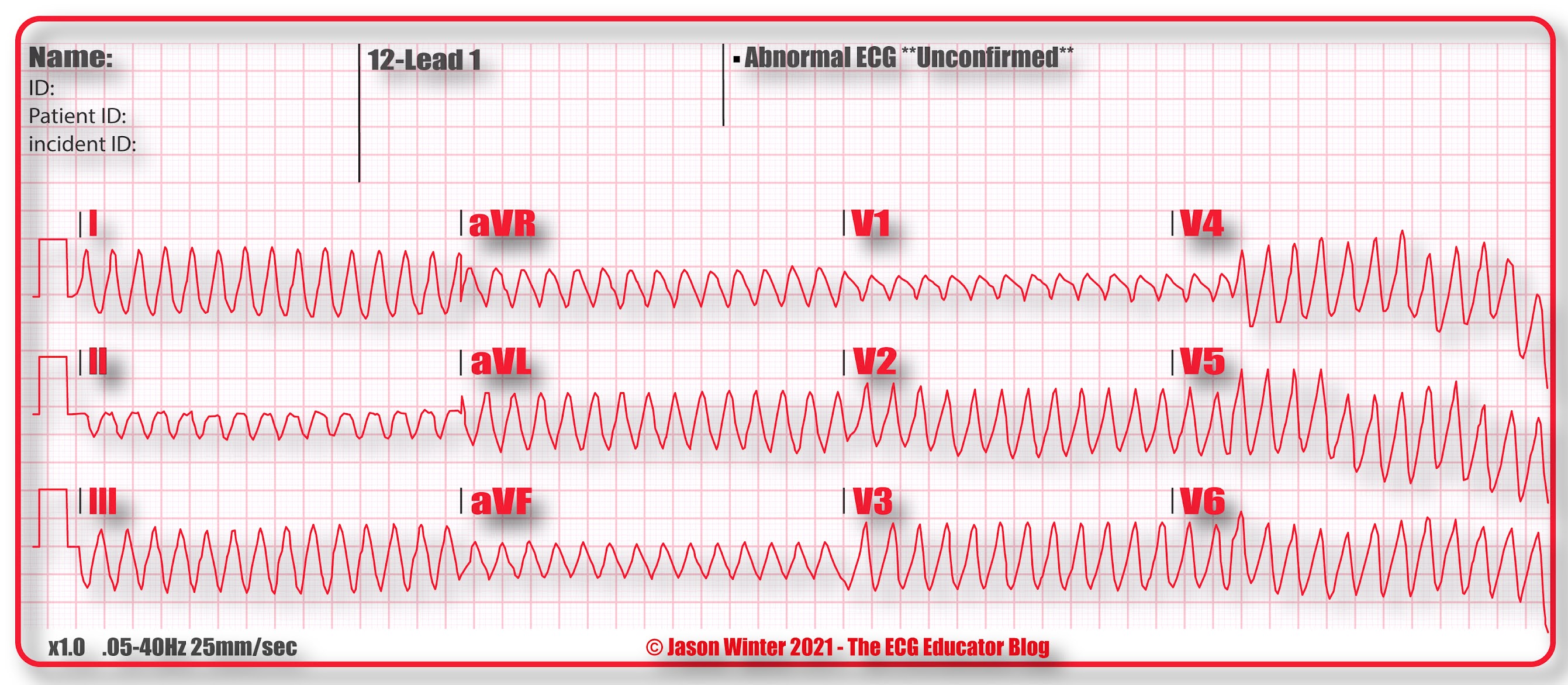 Ventricular Flutter