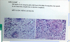VIETNAMESE MEDIC ULTRASOUND: CASE 343: TB AXILLARY NODES, Dr PHAN THANH ...
