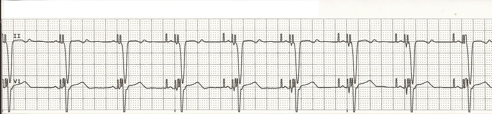 EKG Rhythm Strips 70