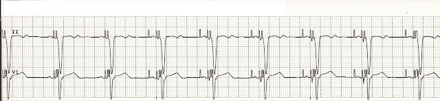 EKG Rhythm Strips 70