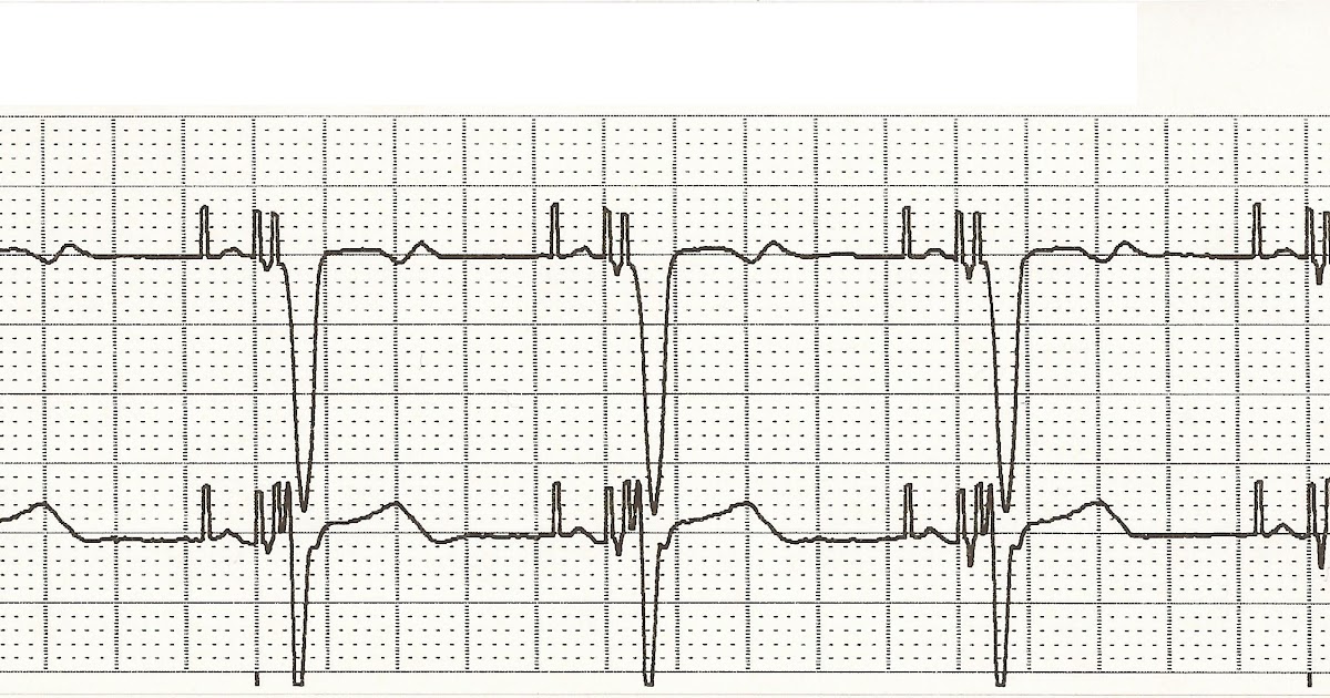 EKG Rhythm Strips 70