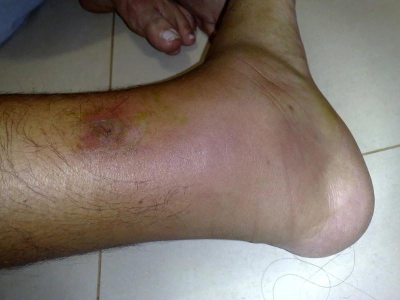 O que fazer em caso de mordidas ou picadas de animais?