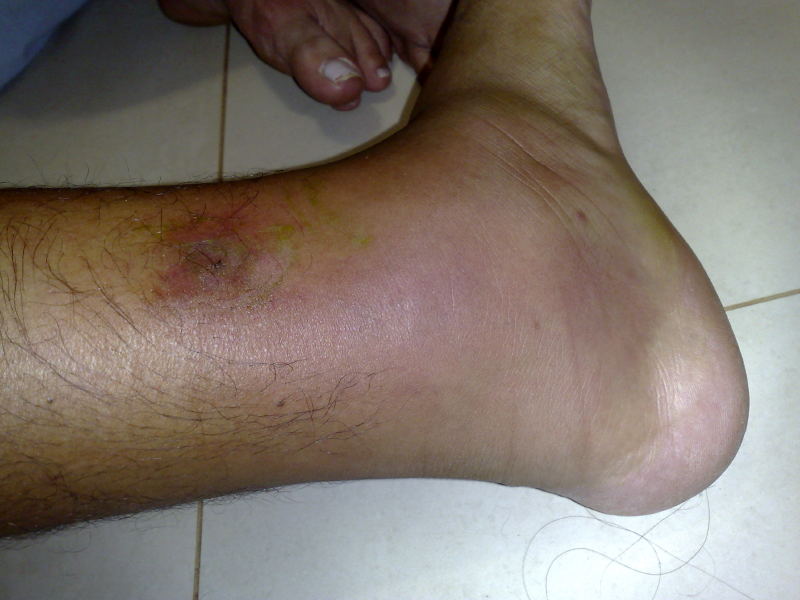 O que fazer em caso de mordidas ou picadas de animais? - O Blog do Mestre