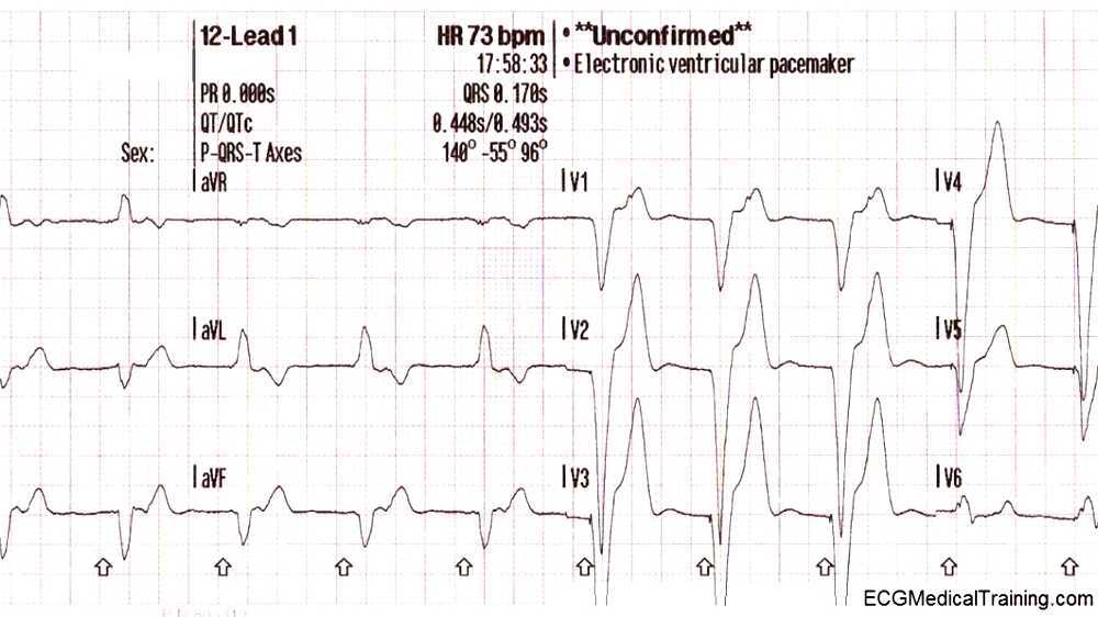 Pacemaker syndrome