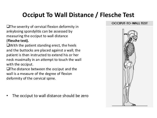 BAMBOO SPINE-ANKYLOSING SPONDYLITIS