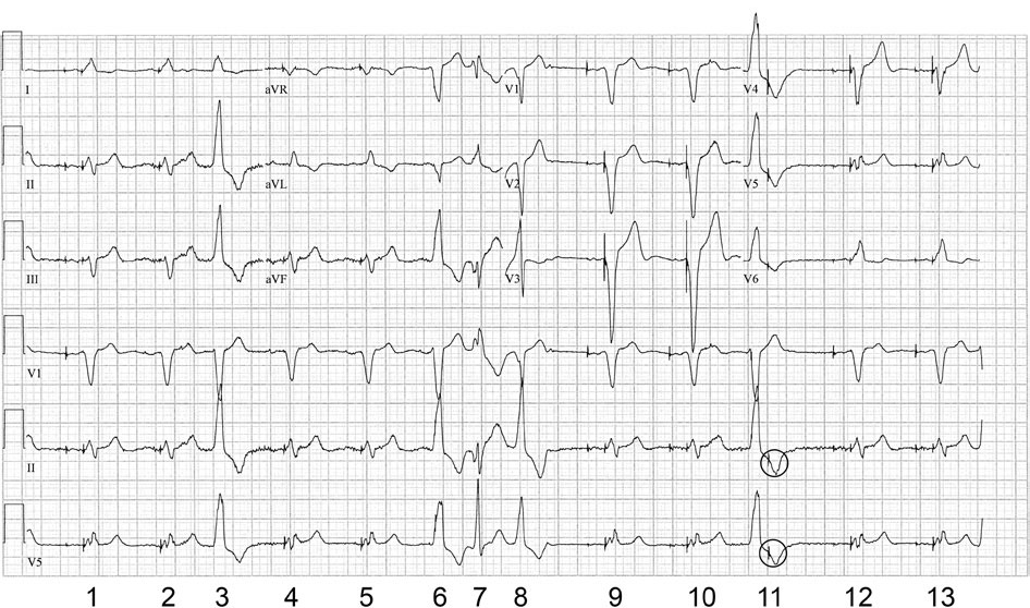 Focus on ECGs: Case #1 - Pacing on the T Wave: What Is the Cause?