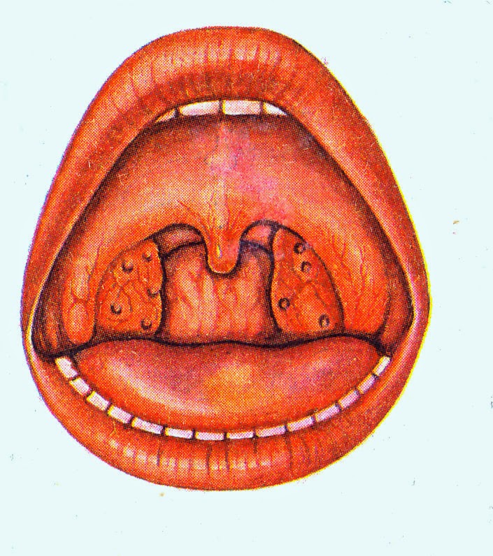 Angina ( acute tonsillitis )|Symptoms of diseases