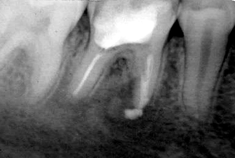 Periapical Abscess Radiograph