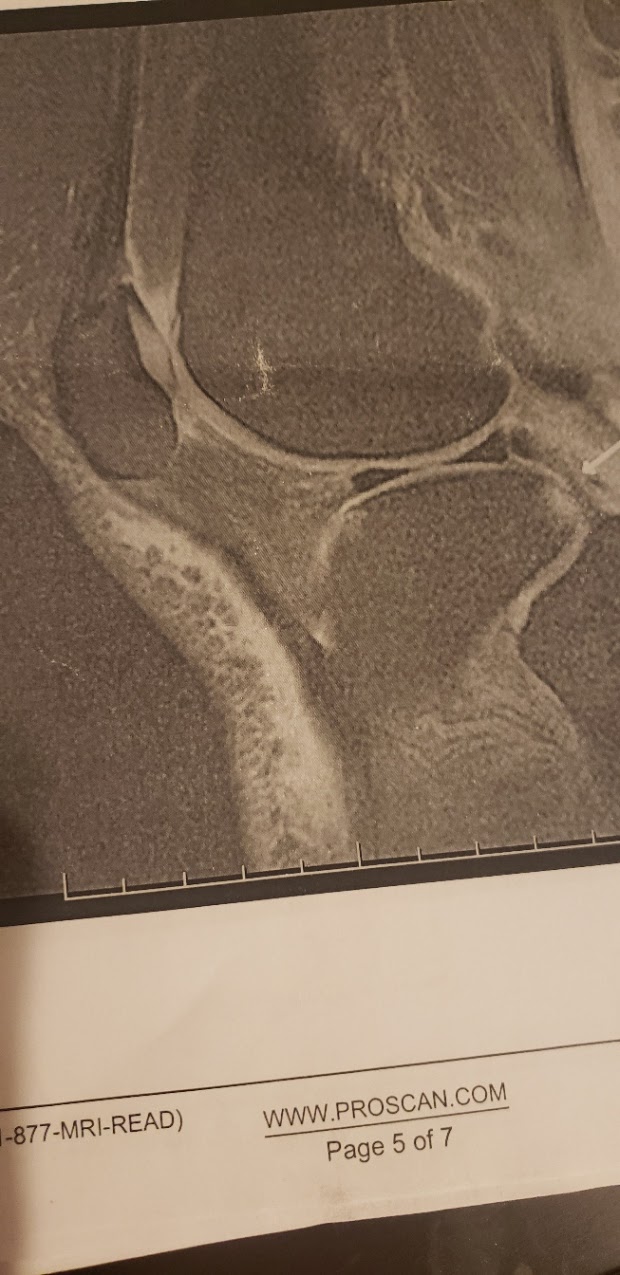 A Glimpse Into My Soul: Updates On My Leg Injury....