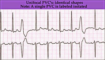 Premature Ventricular Contraction / Ventrikular Ekstrasistol | INA - ECG