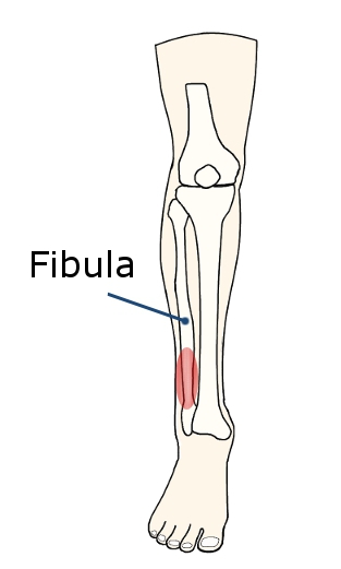 Fibula Fracture Treatment | Fibula Bone Fracture Surgery