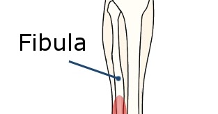 Fibula Fracture Treatment | Fibula Bone Fracture Surgery