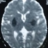 Methanol Poisoning : MRI - Sumer's Radiology Blog