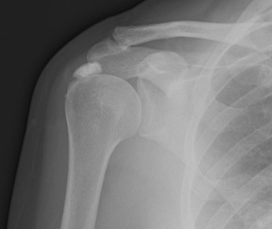 Indiaorthosurgeon: Calcific Tendinitis of Shoulder