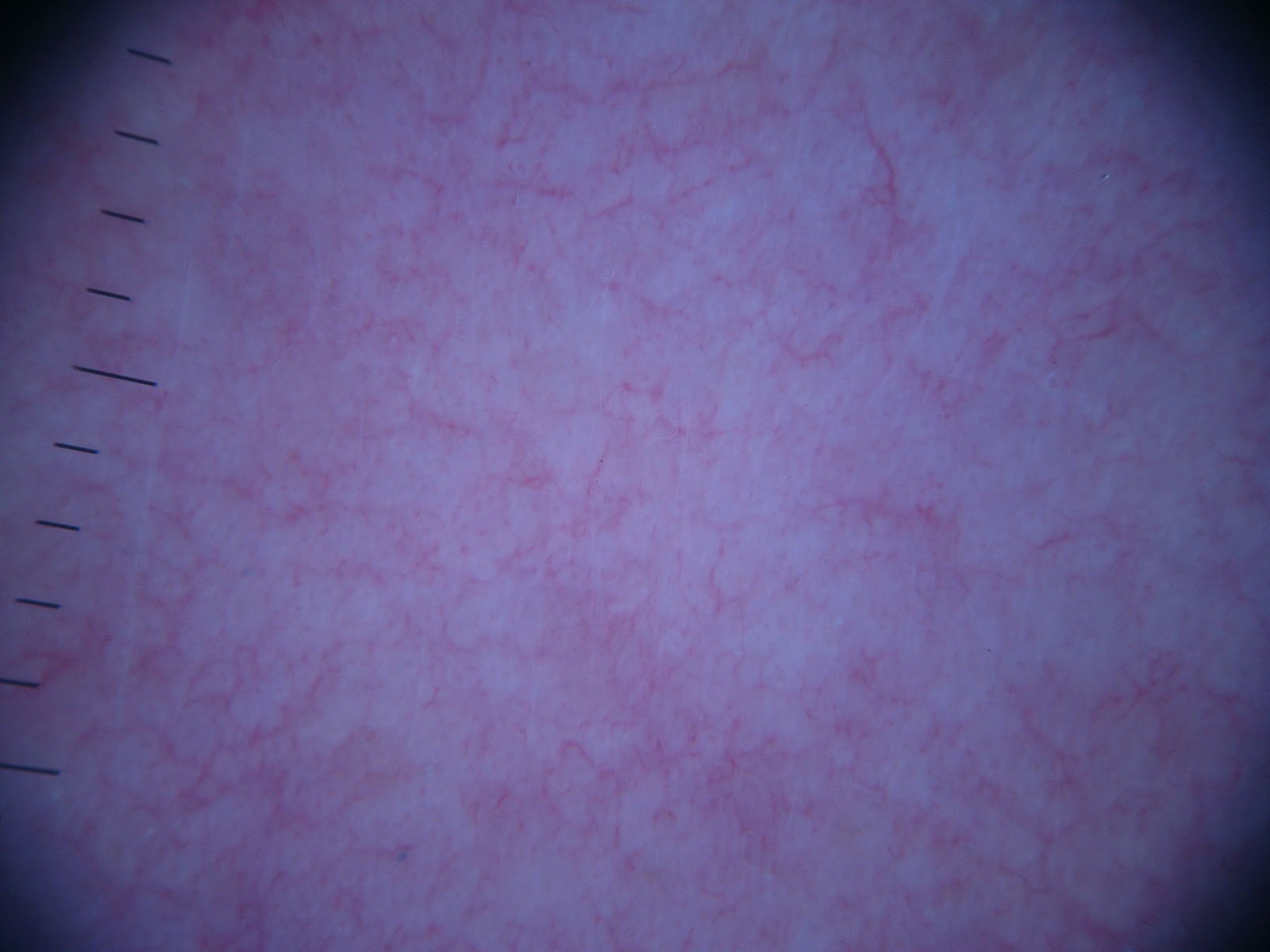 VIRTUAL GRAND ROUNDS IN DERMATOLOGY 2.0: Dermatitis Neglecta