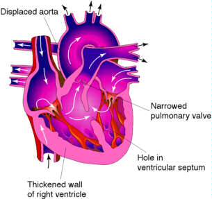 Medical Science: Tetralogy of Fallot