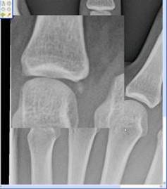Calcific Periarthritis-Plain Film - Sumer's Radiology Blog