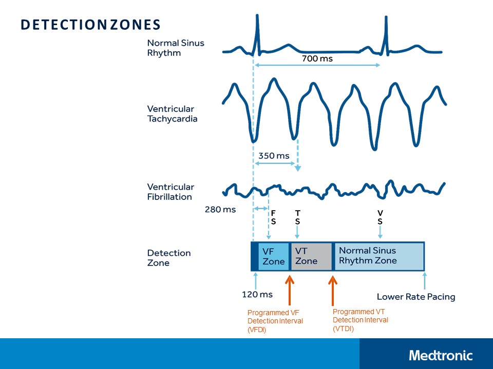 CVT Mohd Farid: Concept Of ICD Technology-Sensing & Detection-Medtronic ...