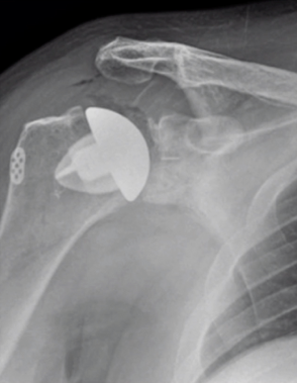 UW Shoulder and Elbow Academy: Overstuffing and the importance of ...