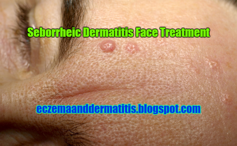 Seborrheic Dermatitis Face Treatment - Eczema and Dermatitis