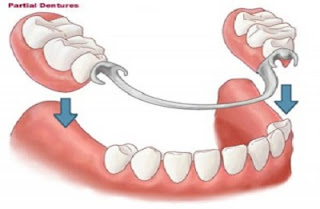 bridge dental : Partial Dentures