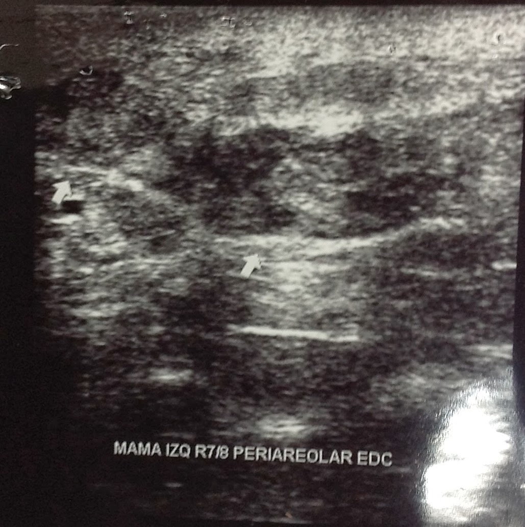 AUTOVACUNAS: Mastitis Infecciosa